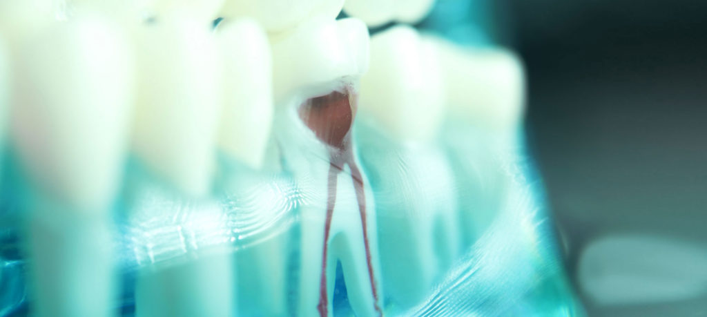 Root Canal Treatment | Cliffside Park, NJ | Cliffside Park Dental